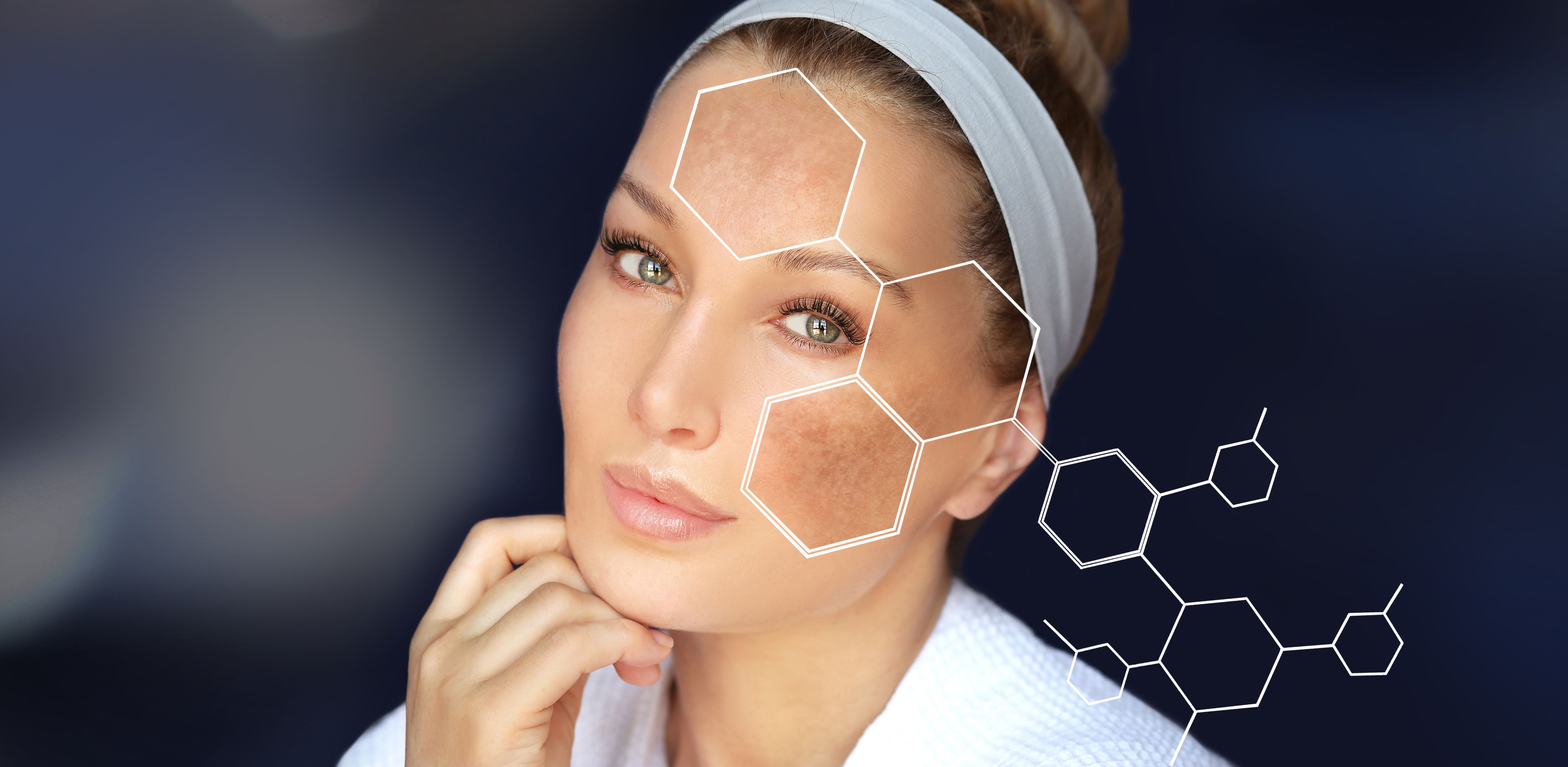 Herausforderung von Pigmentflecken: Ursachen, Prävention & Behandlung. | wellvida ag